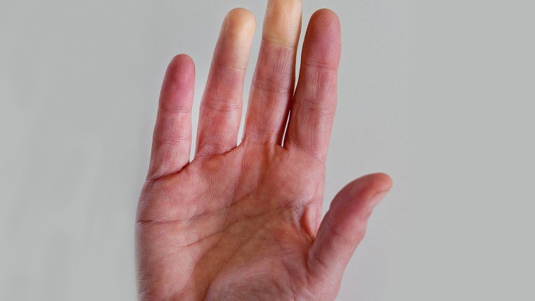 CHOROBA RAYNAUDA: TERAPIA PRZY POMOCY KANNABINOIDÓW - Wolne Konopie